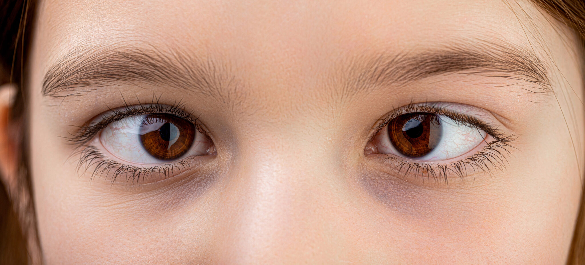 Understanding Squint: Symptoms, Causes, Diagnosis, and Treatment ...